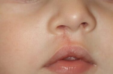 Versorgung von Lippen-Kiefer-Gaumenspalten | Mund-Kiefer ...